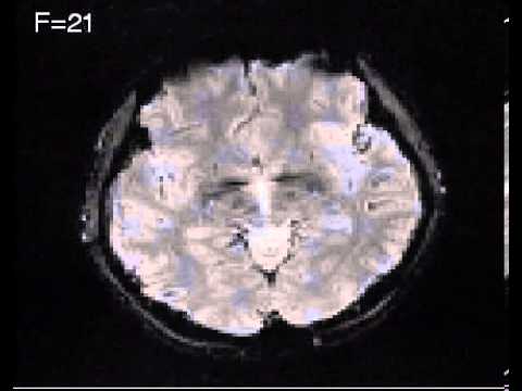 Real-time feedback optimization of z-shim gradient for EPI