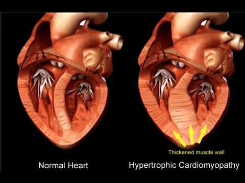 Hypertrophic Cardiomyopathy