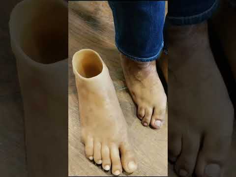 Silicone treatment contact 8003915061 #rehabilitation#prosthesis#jaipur#jaipurfoot#smshospital#viral