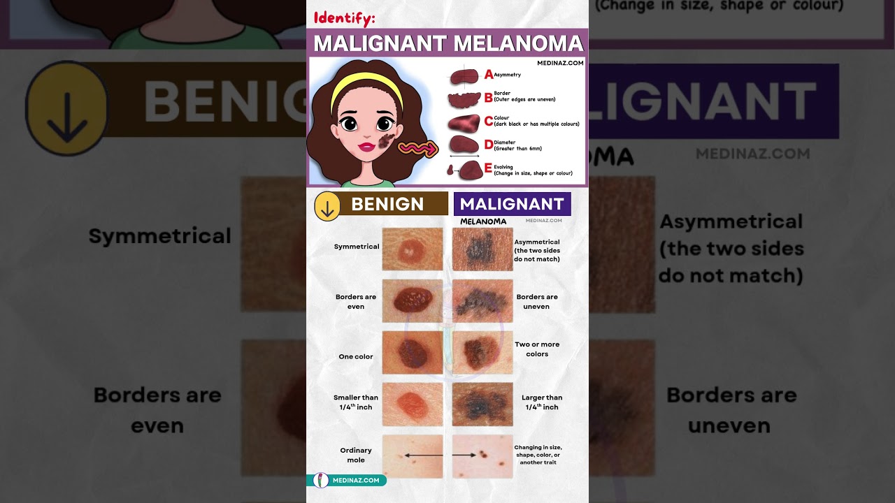 How to Identify Melanoma | Skin Cancer Early Signs