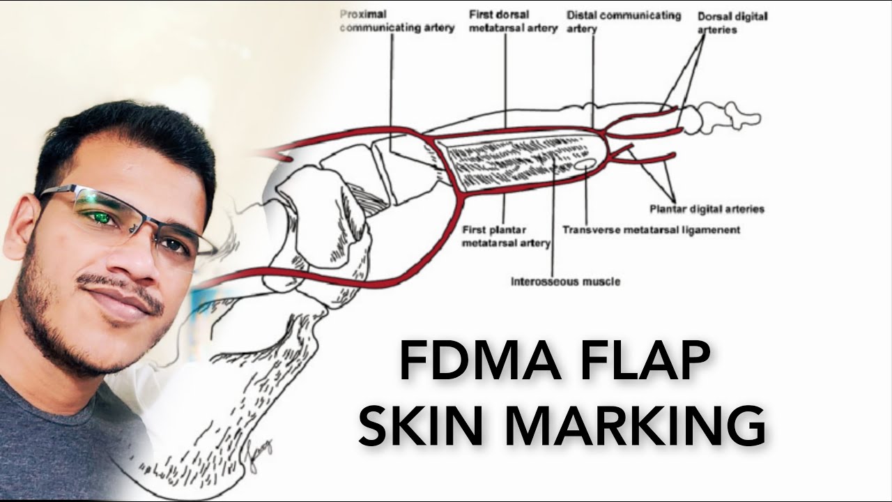 FIRST DORSAL METATARSAL ARTERY FLAP  - FOOT