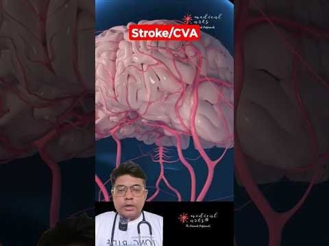 Cerebrovascular accident (CVA)/Stroke #anatomy #doctor #hospital #science