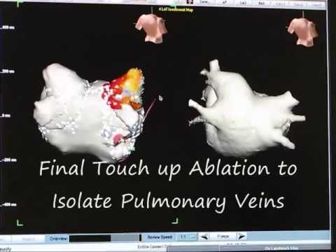 Atrial Fibrillation Ablation (part 3 of 3): How to Perform Pulmonary Vein Isolation