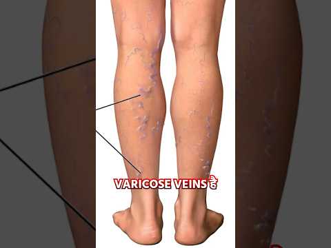 Varicose Vein क्यों और कैसे होता हैं ? Why Do 3/10 People Suffer From Varicose Veins #varicoseveins