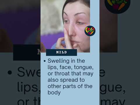 Fish allergy symptoms #Fish allergy symptoms #sea food allergy #shorts #Fishallergy #foodsensitivity
