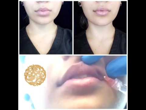 Natural Lip Augmentation Results by Nazarian Plastic Surgery in Beverly Hills