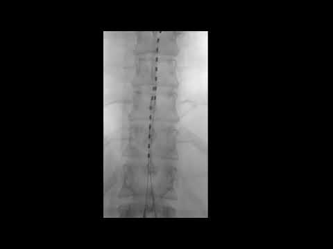 Comparing Spinal Cord Stimulators: Percutaneous vs. Paddle Leads