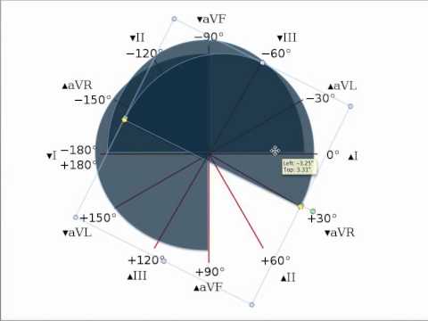 Easy EKG: Mean Electrical Axis Made Easy!