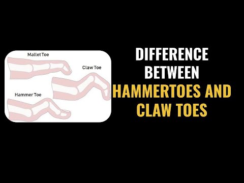 Hammer Toes vs Claw Toes (vs MALLET TOES) - Quick INFO