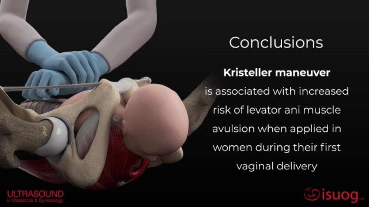 Kristeller maneuver is associated with increased risk of levator animuscle avulsion