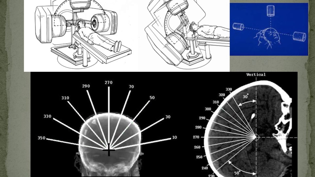 SRS Lecture 2 Stereotactic Imng w audio