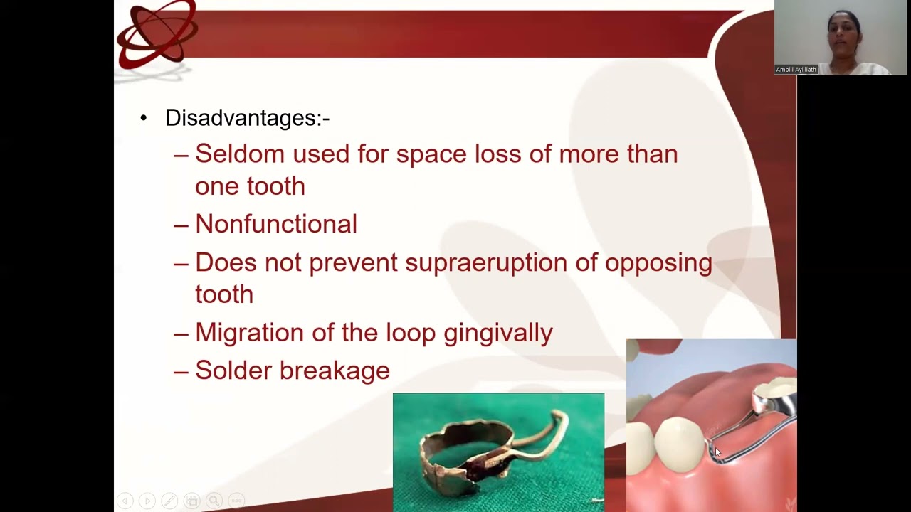 SPACE MAINTAINERS |DEPARTMENT OF PEDODONTICS | Dr AMBILI AYILLIATH