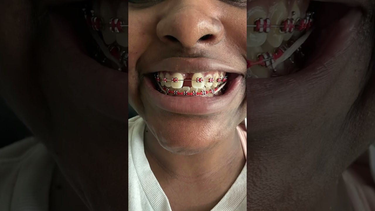 Officially 1 year in #braces! Watch how my gap has closed. #orthodontics #update #journey #dentist