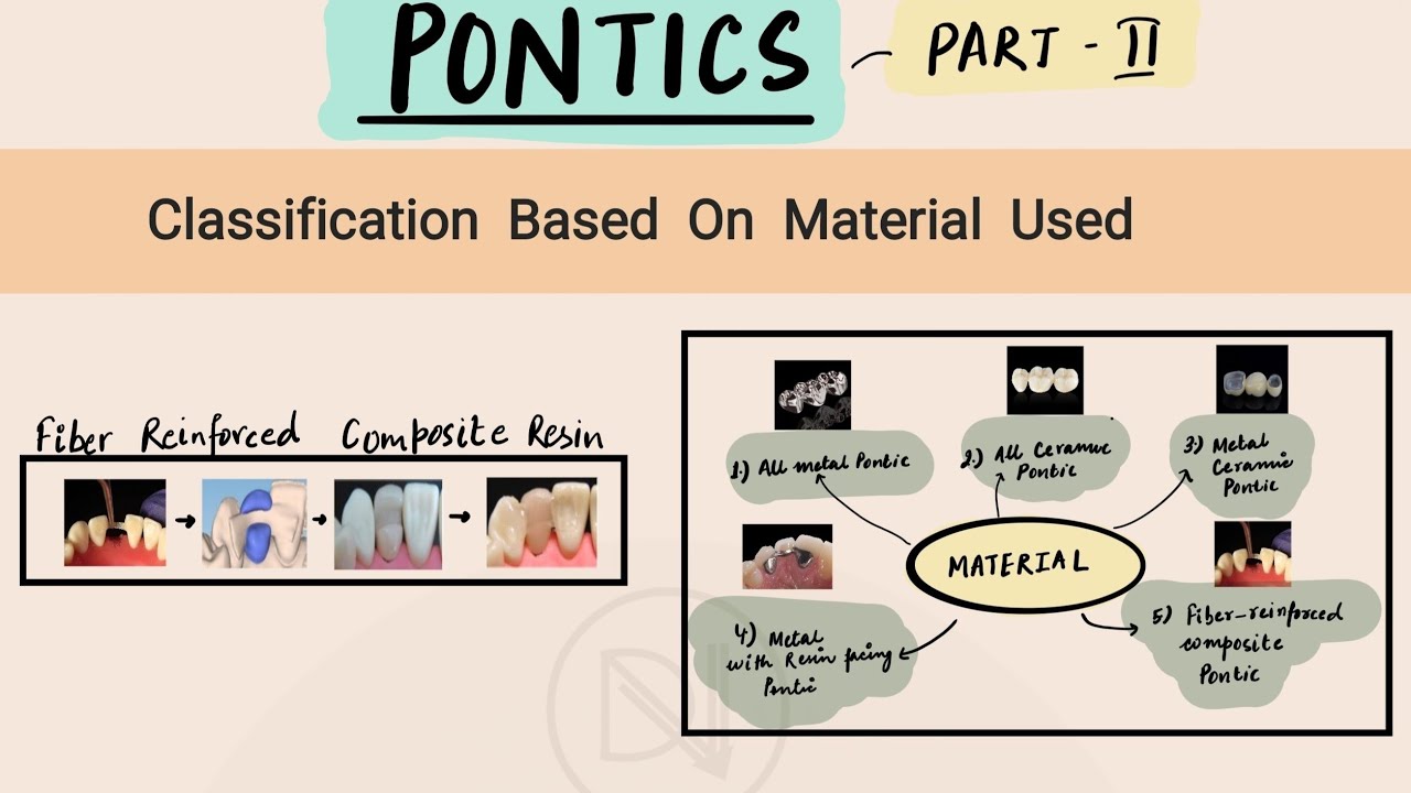 Pontics classification Based  on materials used ( part 2 )