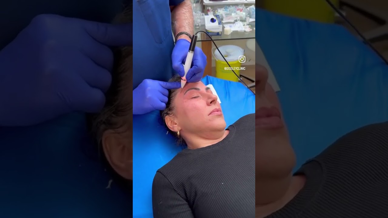 Plexr Eye Lift | Dr. Mark demonstrates the Jett Plasma #eyelift