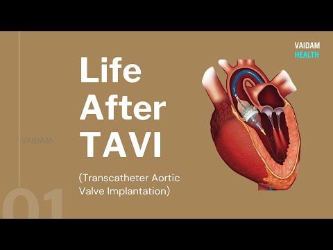 Life After TAVI (Transcatheter Aortic Valve Implantation)