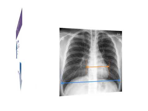 Cardiothoracic ratio (CTR) in Chest X ray and CT