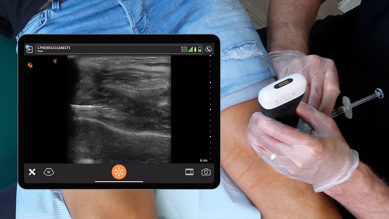 Hyaluronic Acid Knee Injection