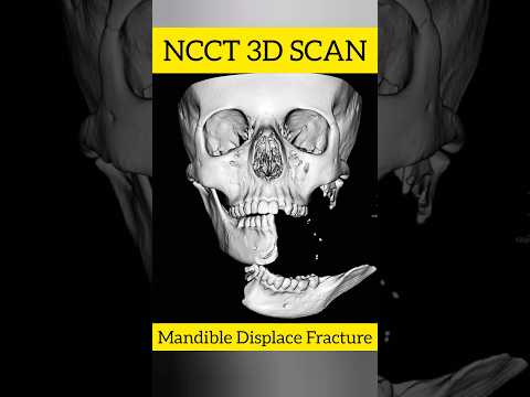 Lower Jaw Fracture #medicalimaging