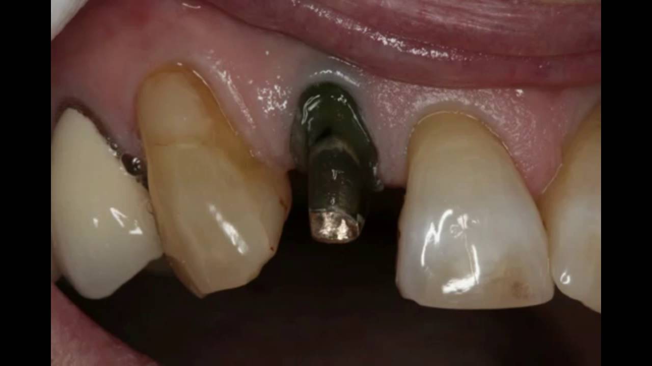 Mariner Dental  Restoration