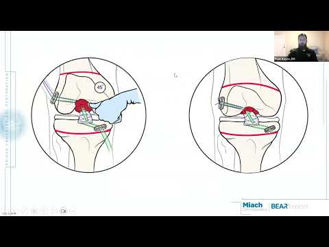 BEAR Implant Considerations in Adolescents & The Young Athlete | Webinar with Drs. Keyes and Nathe
