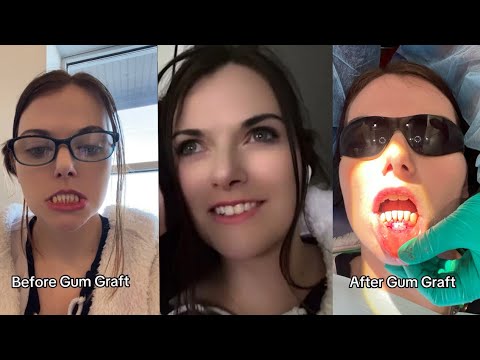 My dental gum graft surgery experience.