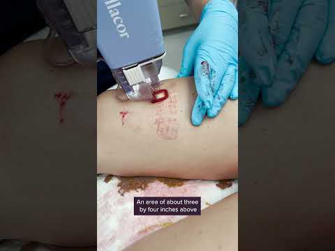 Ellacor — Off-Label Use on the Knees