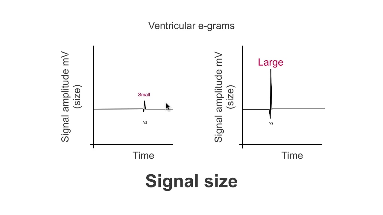 Pacemaker sensing and fixed sensitivity.