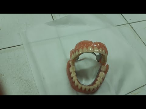 Finition de la prothèse totale en stellite.