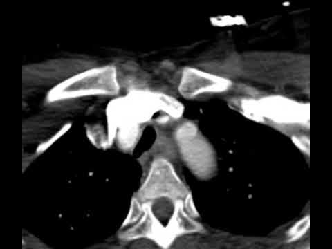 Gated CT Chest Angiography, Bicuspid Aortic Valve