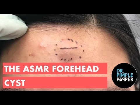 Dr. Pimple Popper Pops 'ASMR' Forehead Cyst In Youtube Video