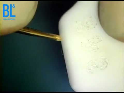 ApicoEctomy Clinical Case by Dr Baek