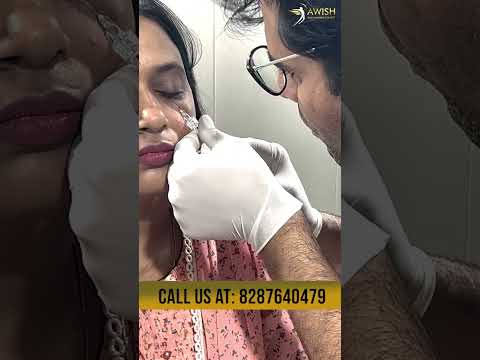 What is this ? ЁЯе╣ЁЯе╣Under eye filler / Dark circles treatment