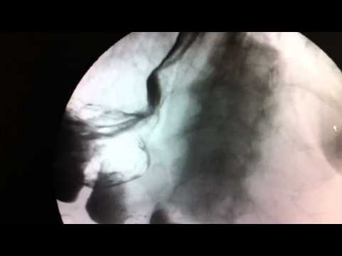 Schatzki ring of oesophagus
