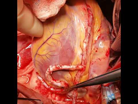Dr. Viacheslav Bobovnikov Heart Procedure