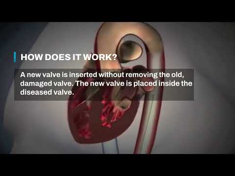 Transcatheter aortic valve implantation (TAVI)