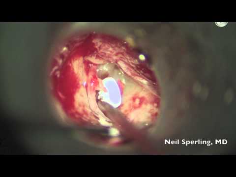 Stapedotomy Prothesis Placement by Neil Sperling, MD