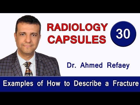 Capsule 30 : Examples of How to Describe a Fracture