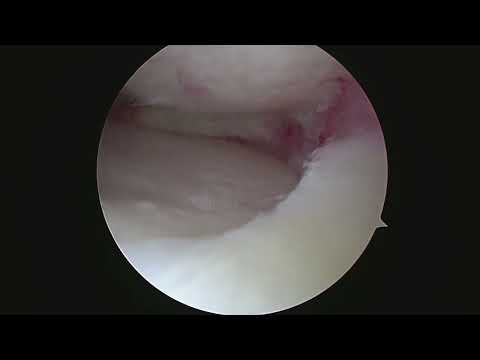 Knee Arthroscopy: Partial Medial Meniscectomy (Meniscus Surgery in a Patient with Mild Arthritis)
