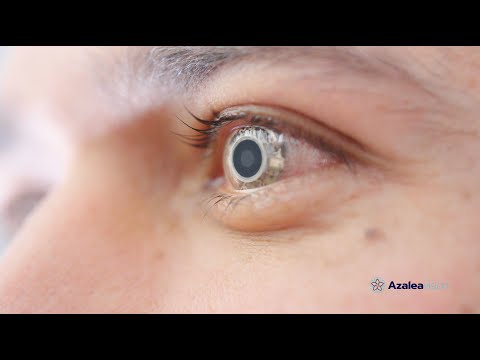 ALMA lens, the revolutionary smart contact lens by Azalea Vision