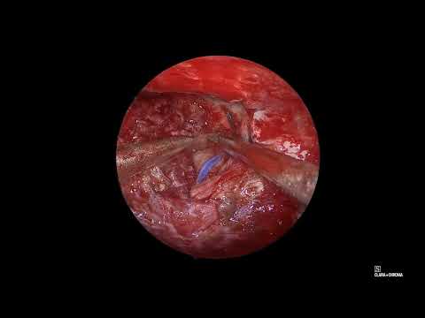 Endoscopic Endonasal Approach for Excision of Tuberculum Sellae Meningioma