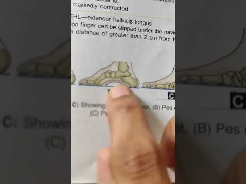 Normal foot, pes cavus foot, pes planus foot deformity #physiotherapy