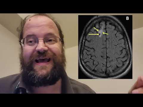 Diffuse Axonal Injury (DAI) : Understanding the primary mechanism behind traumatic brain injury.