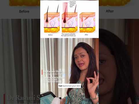 Lasers Hair Reduction: How does it really work? By Dr Rashmi Shetty