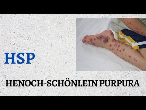 Henoch-Schönlein Purpura|| HSP