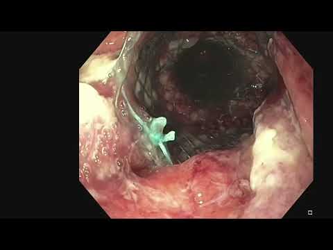Endoscopic Management of Full Thickness GI Defects