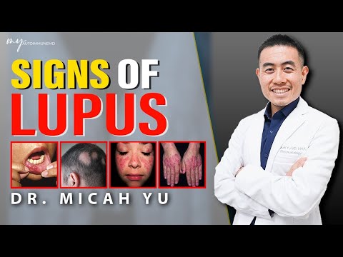 10 SIGNS of Lupus TO NOT MISS From a Rheumatologist | Dr. Micah Yu