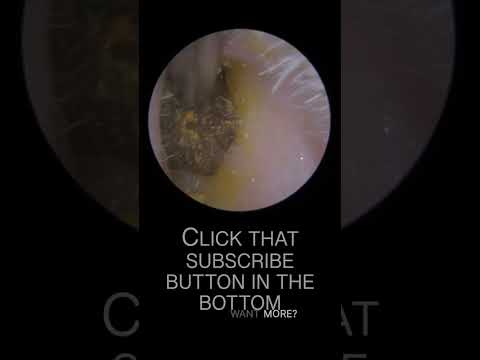 LARGE EAR WAX PLUG REMOVAL