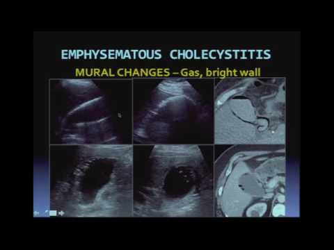 Ultrasound Imaging of Complicated Inflammatory Gallbladder Disease