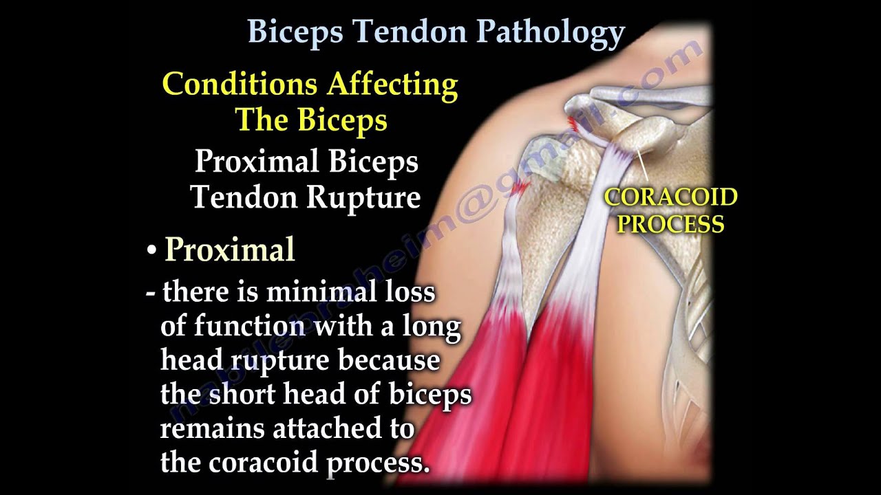 Biceps Tendon Pathology - Everything You Need To Know - Dr. Nabil Ebraheim
